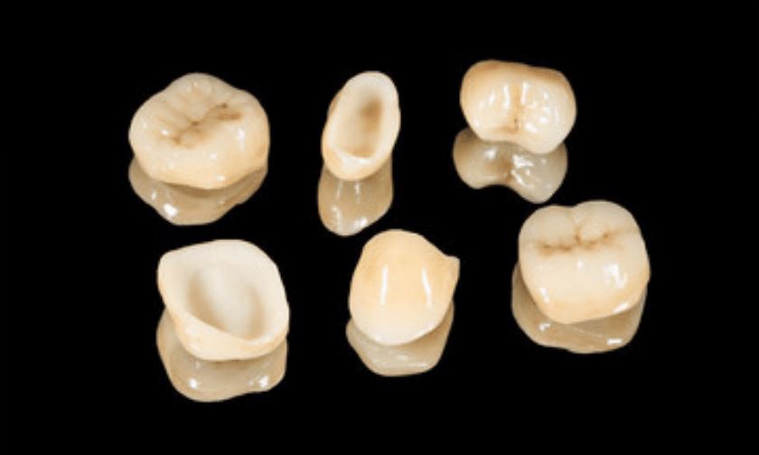 Why Same-Day CEREC Crowns Is a Better Option?